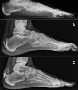 Signes d’une décalcification osseuse et soins adéquats